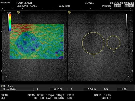 Elastogram From A Tissue Mimicking Phantom Displaying A Spherical