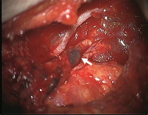 A Thrombus Was Detected In The Venous Anastomosed Site Arrow