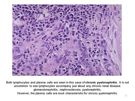 Pyelonephritis 1 Contents Definition Types Etiology Clinical Features