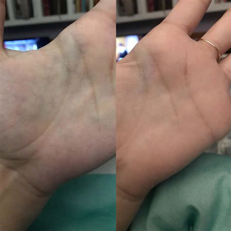 Blue Veins Dream Meaning At Alejandro Harden Blog