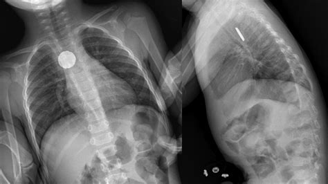 Case 2 Radiograph Revealing The Presence Of A Button Battery With Download Scientific Diagram