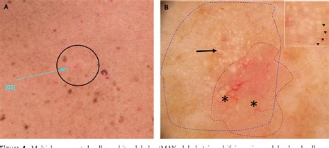 Figure 1 From White Globules In Basal Cell Carcinoma A Dermoscopic