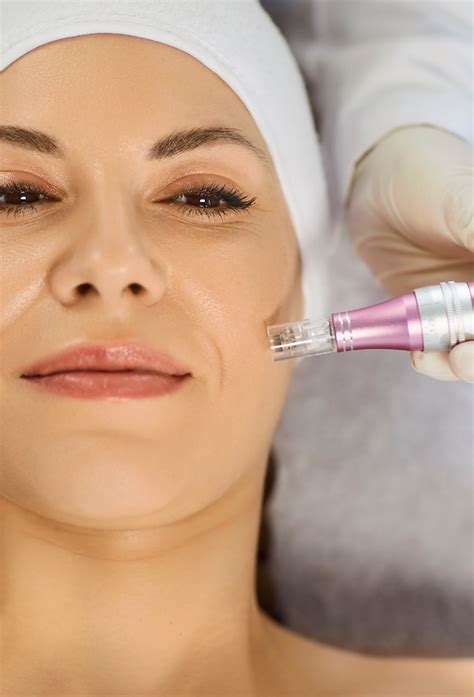 Microneedling Sudbury Skin Rejuvenation And Acne Scar Treatment The