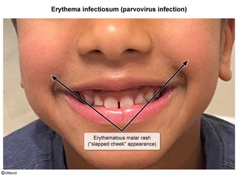 Streptococcal Pharyngitis Ear Nose And Throat Uworld Medical Library