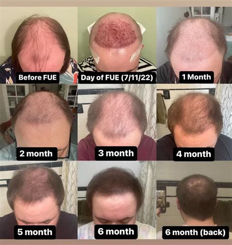 Hair Transplant Healing Timeline Stages Of Recovery Explained