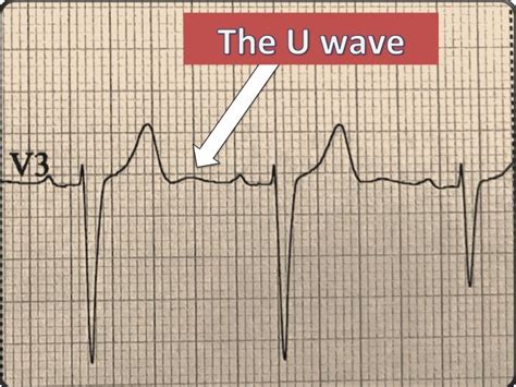 The U Wave — The Pr