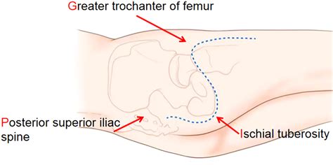 Frontiers Surgical Resection Of Malignant Tumors At The Ischial