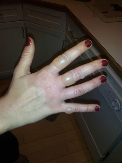 Girlfriends Hand With Serious Steamer Burn Rwtf