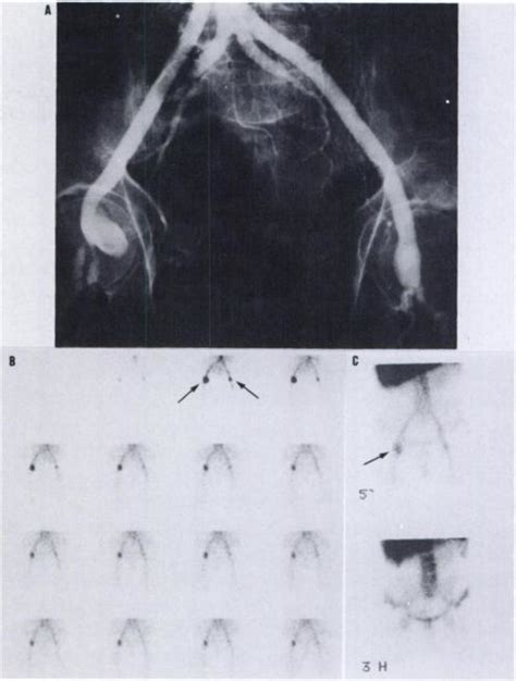 Noninfected Bilateral Pseudoaneurysms A Angkg Download