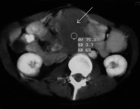 What Desmoid Tumors Look Like A Visual Guide Mydesmoidtumorteam