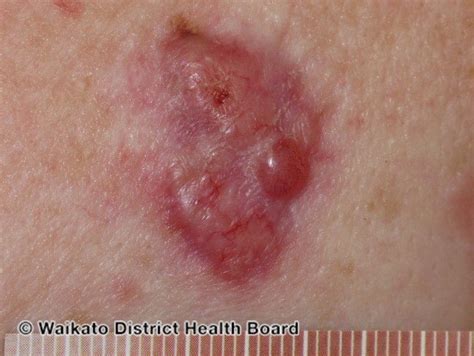 What Causes Superficial Basal Cell Carcinoma