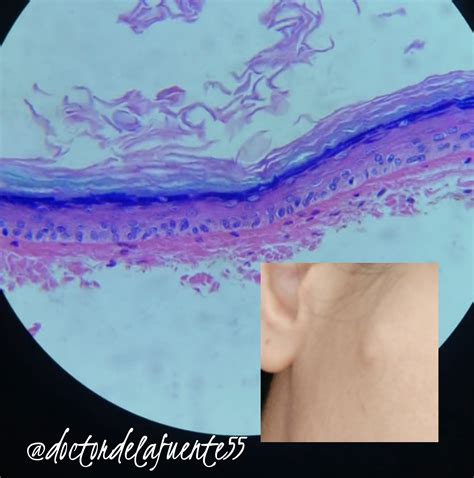 Doctor De La Fuente Un Quiste Epidermoide Es Un Saco Con Características Benignas Que Se