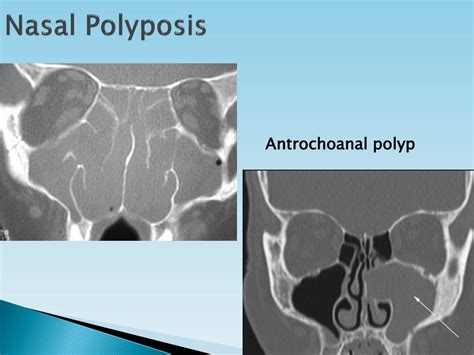 Ppt Imaging For Ent Powerpoint Presentation Free Download Id1329697