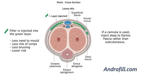 Penile Filler Injections Penile Injections A Patient Guide Elxjc