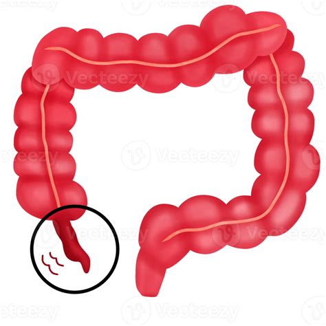 Appendicitis Disease Inflamed Human Appendix And Colon Diagram