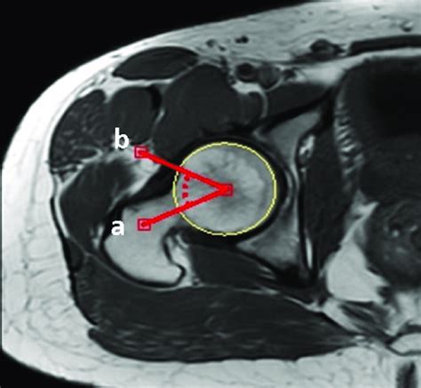 Measurement Of Alpha Angle On Oblique Axial T1 Weighted Mr Images
