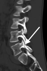 Surgical Repair Of Pars Interarticularis Fractures Spine Surgeon