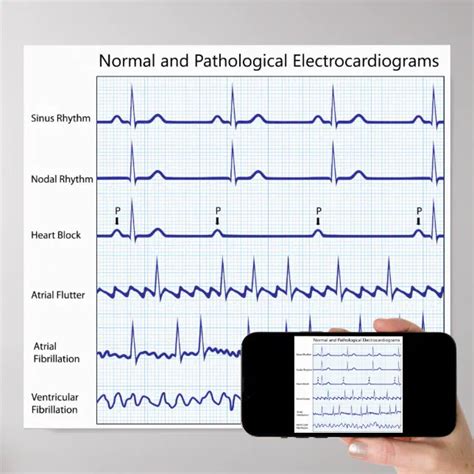 Normal And Pathological Ecg Poster Zazzle