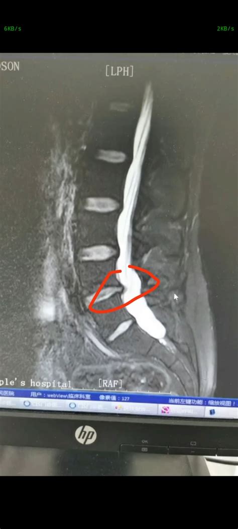 My Story With Sciatica R Sciatica