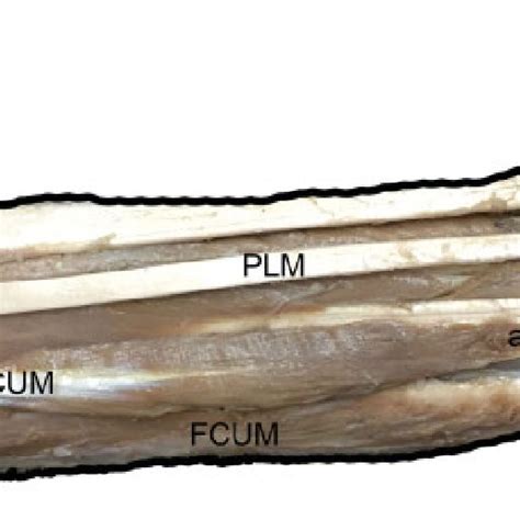 Anterior View Of The Dissected Forearm Abbreviations Afcum Accessory