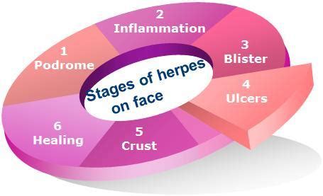 Herpes On Face Treatment How To Cure Facial Herpes Definitively
