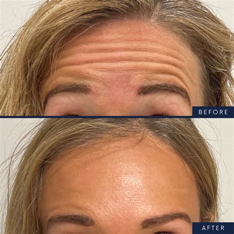 The Truth About Treating Wrinkles In Kelowna Bc Dr Kaleb Falk