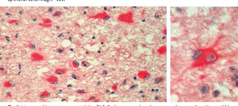 Figure 3 From Crosstalk In Human Brain Between Globoid Cell