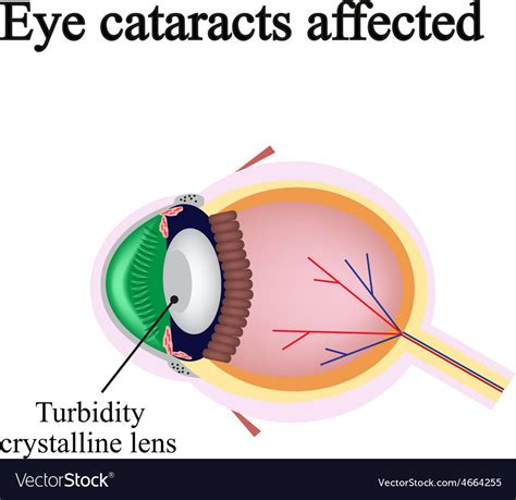 Structure Of The Eye Cataracts Affected Royalty Free Vector