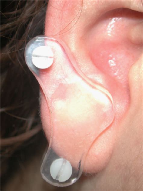 Ear Keloid Pressure Clips At Helene Winkleman Blog