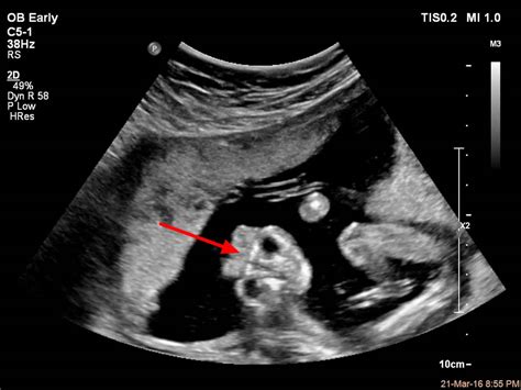 Anencephaly Causes Symptoms Diagnosis Prognosis And Anencephaly Treatment