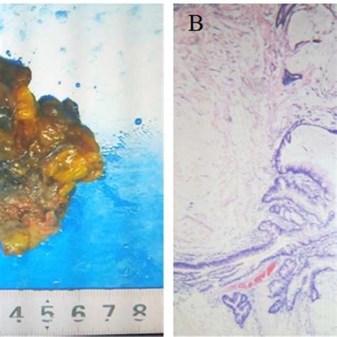 A Ultrasonographic Image Showing A Solid Mass Above The Bladder