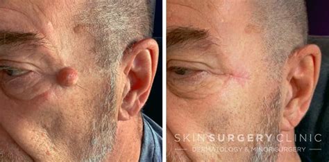 Cyst Removal From £495 Skin Surgery Clinic