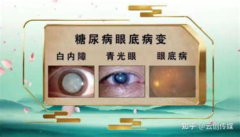 糖尿病视网膜病变 知乎