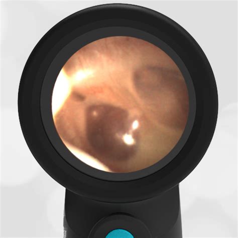 Middle Ear Effusion Wiscmed