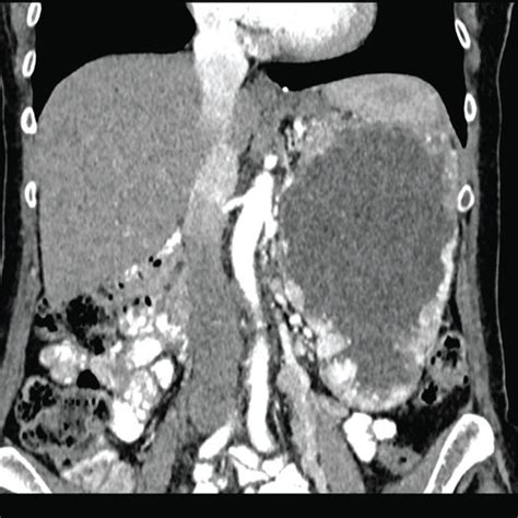 Ct Showing Confirmed A Large Malignant Looking Left Renal Mass With