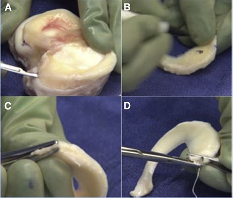 Meniscal Allograft Transplantation With Soft Tissue In Bone Socket