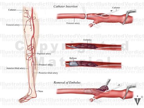 Stock Lower Limb Clots Plaques In Vasculature — Illustrated Verdict