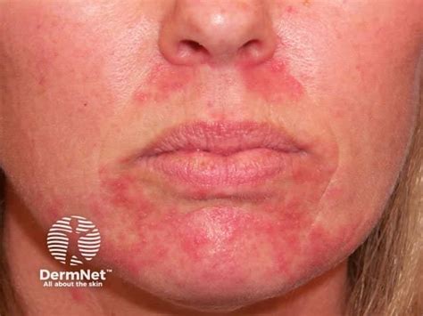 Follicular Disorders Perioral Dermatitis