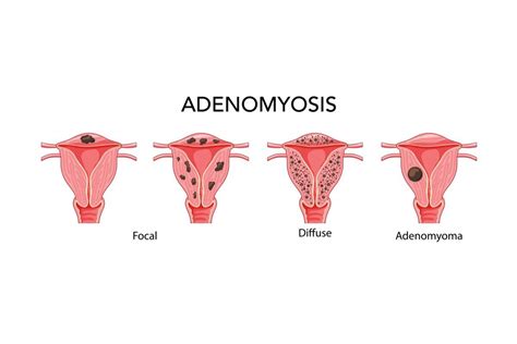 Endometriosis And Adenomyosis What Is Adenomyosis Myoovi