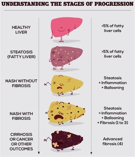 The European Fight Against Nash The Silent Liver Disease Artofit