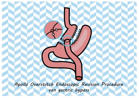 Tore Procedure Obesitascentrum Az Delta