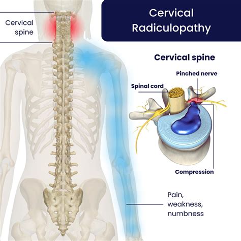Cervical Radiculopathy Treatment Specialist In Brooklyn Nyc And Nj