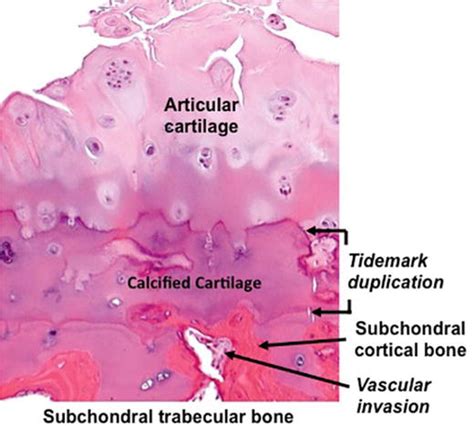 Subchondral What Is Subchondral Sclerosis