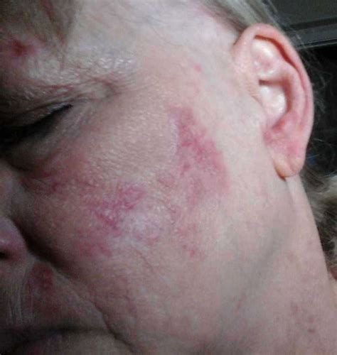 Cutaneous Lupus Face Cutaneous Lupus Face