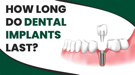 How Long Do Dental Implants Last Youtube