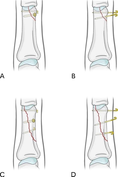 A K Wire Combined With One Screw B Two K Wires C Two K Wires Combined