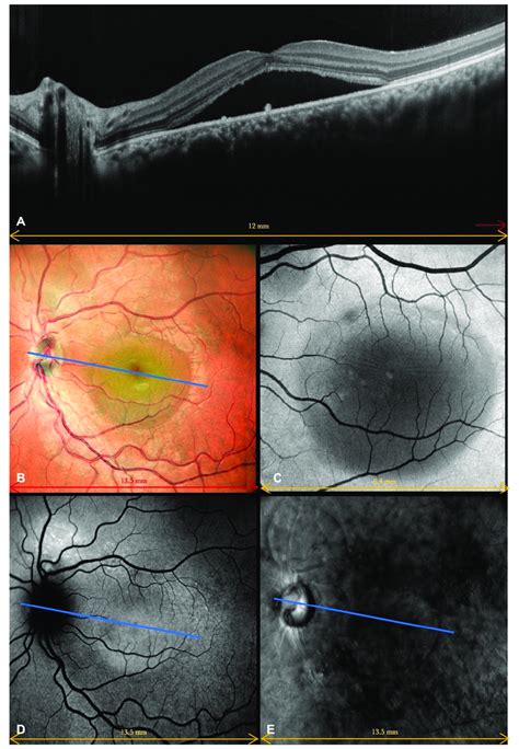 A 30 Year Old Female Patient Best Corrected Visual Acuity In The Left Download Scientific
