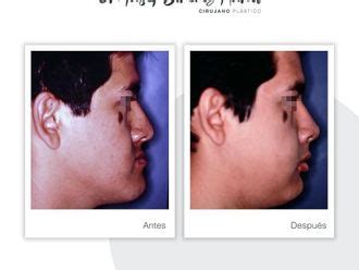 Cirugía Maxilofacial Antes Y Después Multiesteticamx