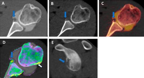 Figure 2 From Dual Energy Ct Arthrography Advanced Muscolo Skelatal