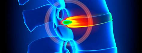 Protrusão Discal é Tipo De Hérnia De Disco Dr Alberto Gotfryd